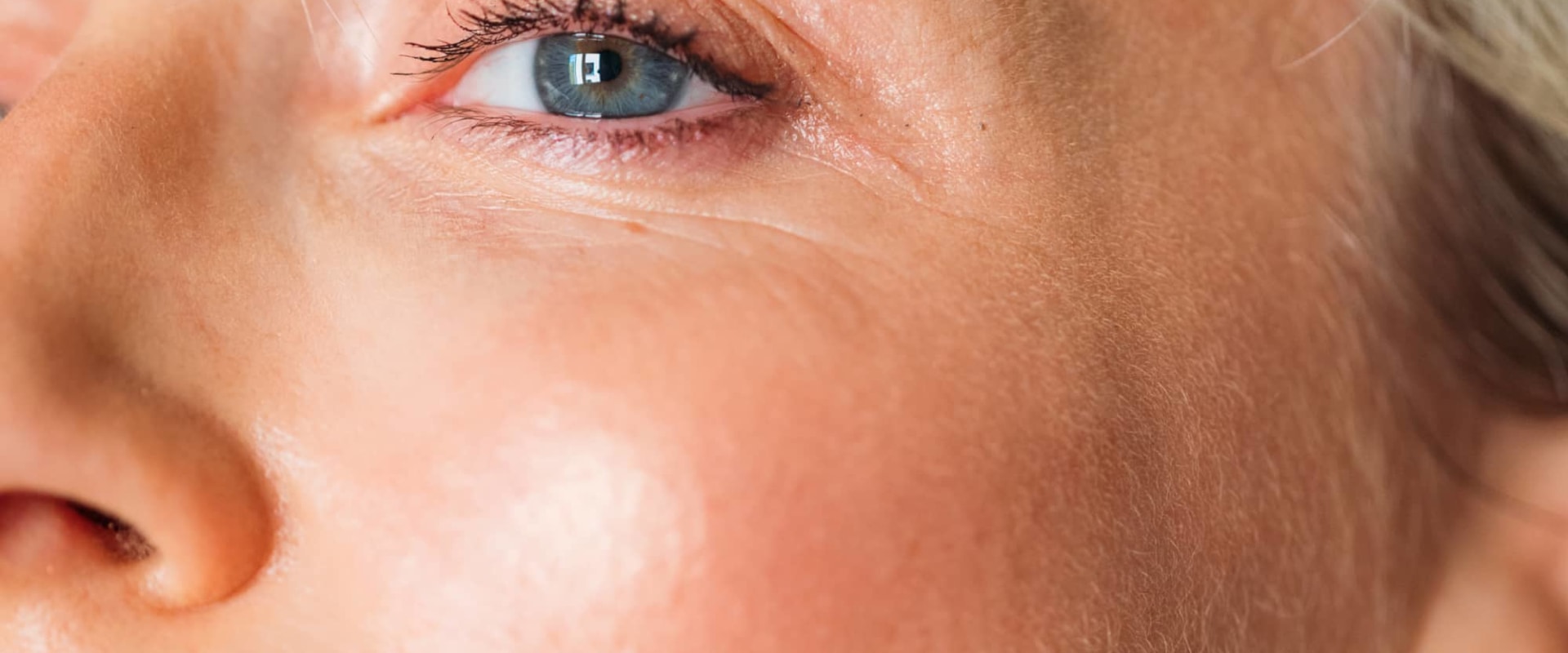 Do fillers cause hard lumps under the skin?